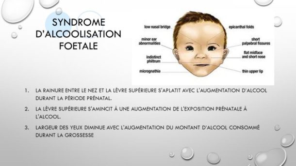 Le syndrome d’alcoolisation fœtale (SAF) - côtébébé